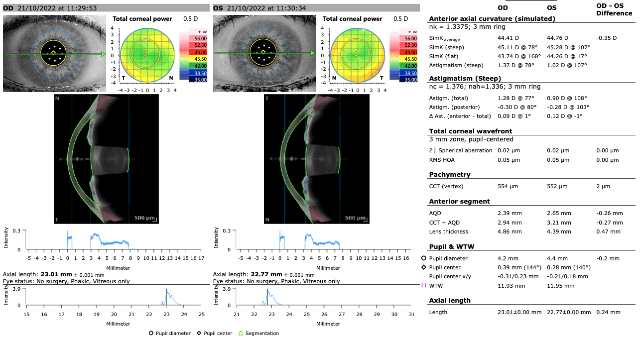 BIOMETRIA ÓPTICA - IOL Perdizes