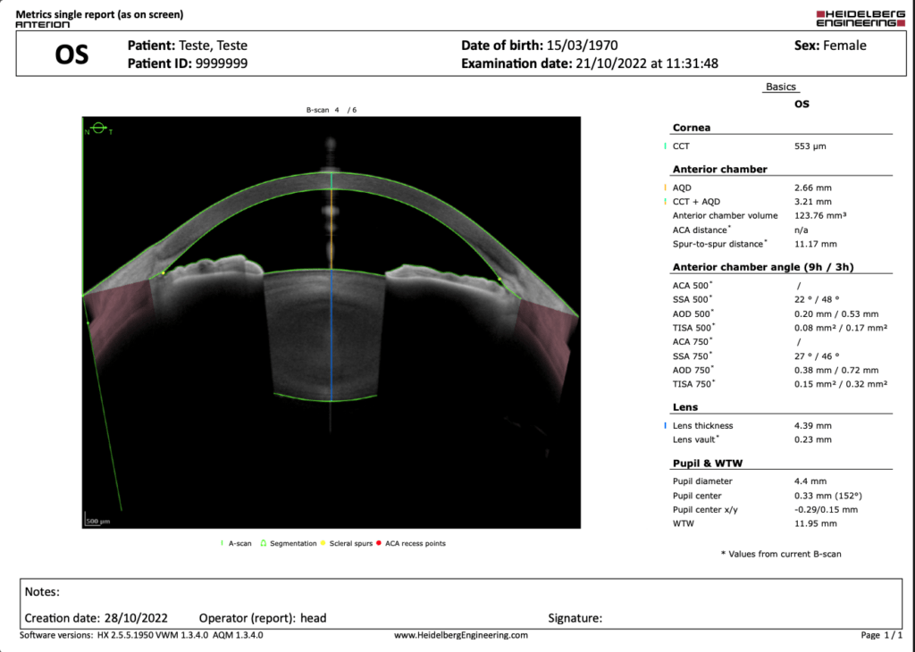OCT DE SEGMENTO ANTERIOR - IOL Perdizes